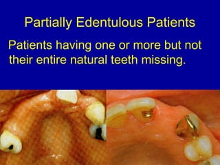 introduction to prosthodontics | PPT