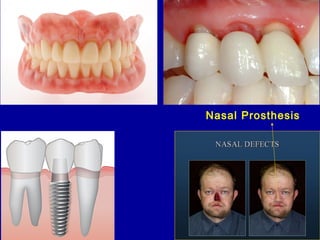 introduction to prosthodontics | PPT