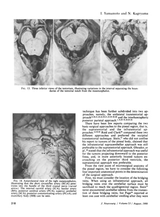 Microsurgical anatomy of the pineal region | PDF