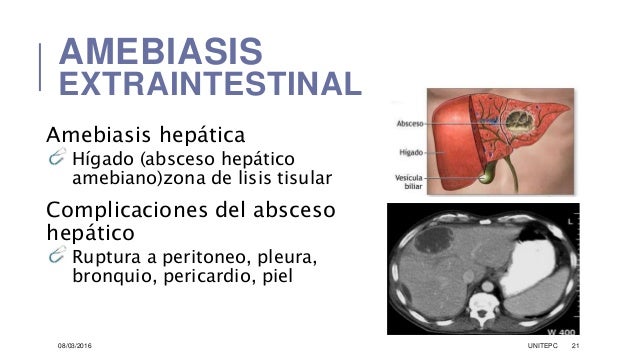 Amebiasis