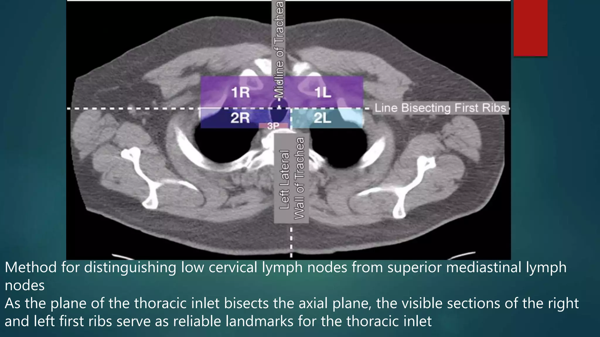 radiological anatomy of thoracic lymph nodes | PPTX