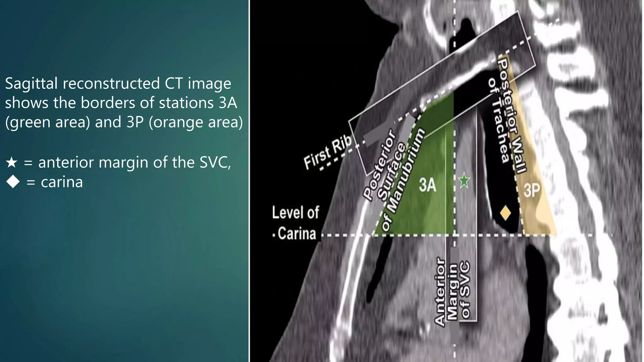 radiological anatomy of thoracic lymph nodes | PPTX