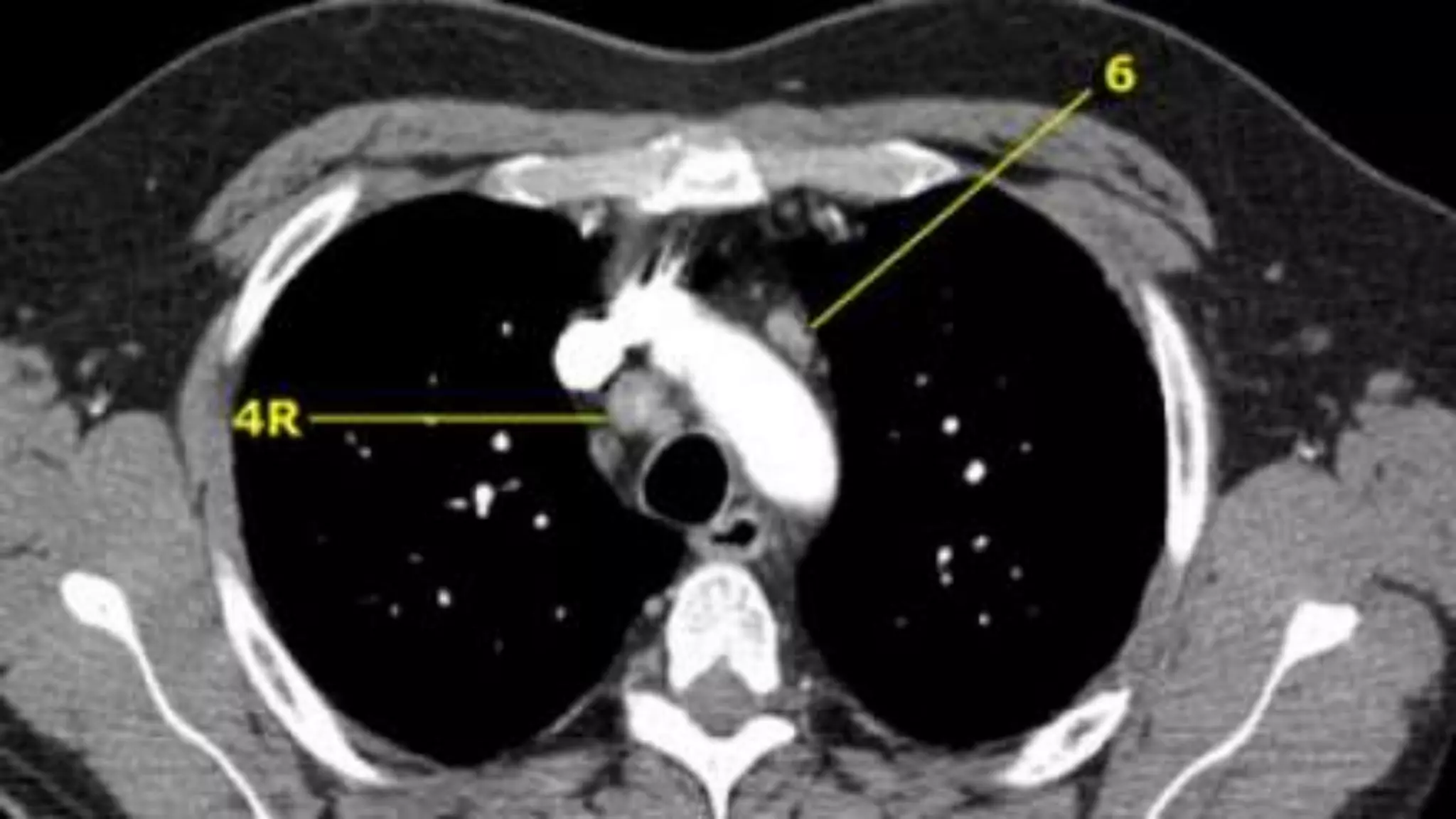 radiological anatomy of thoracic lymph nodes | PPTX