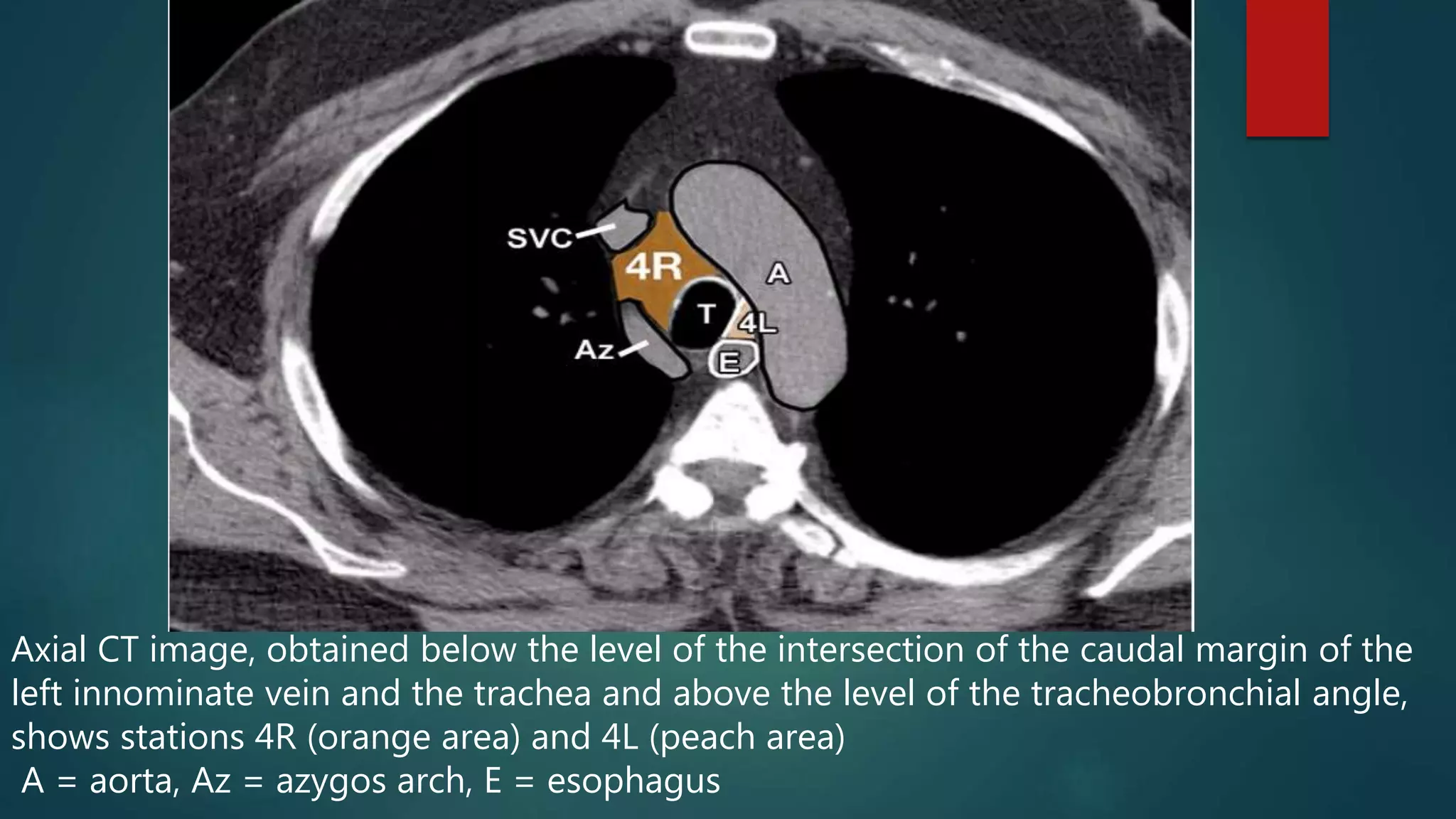 radiological anatomy of thoracic lymph nodes | PPTX