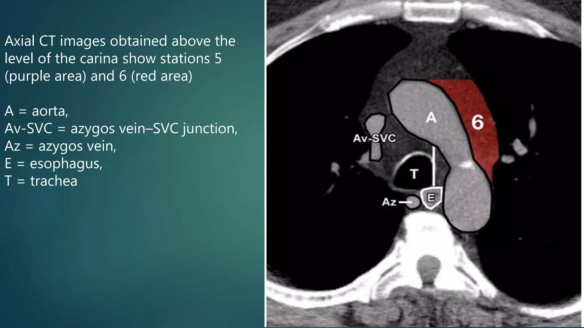 radiological anatomy of thoracic lymph nodes | PPTX
