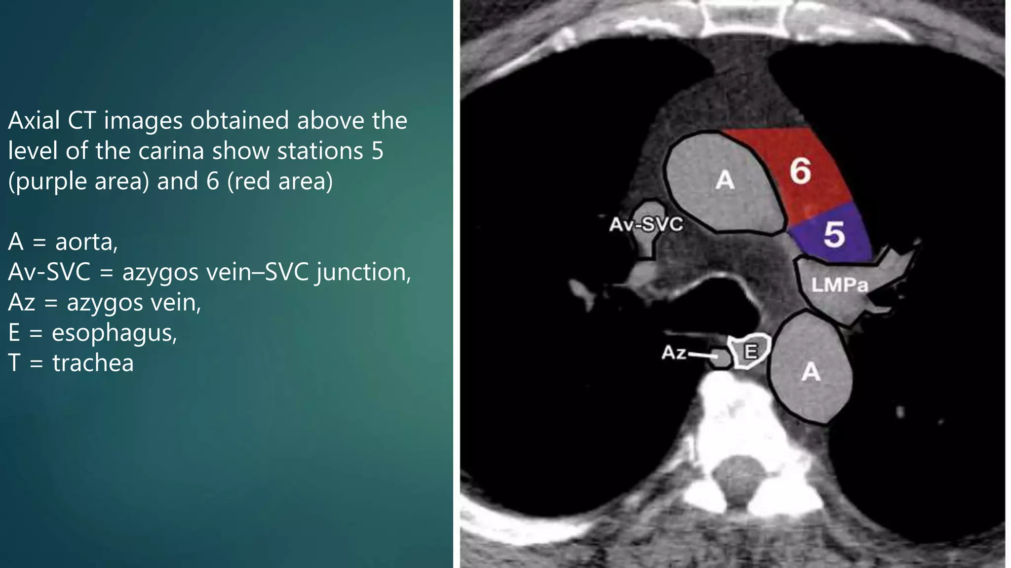 radiological anatomy of thoracic lymph nodes | PPTX