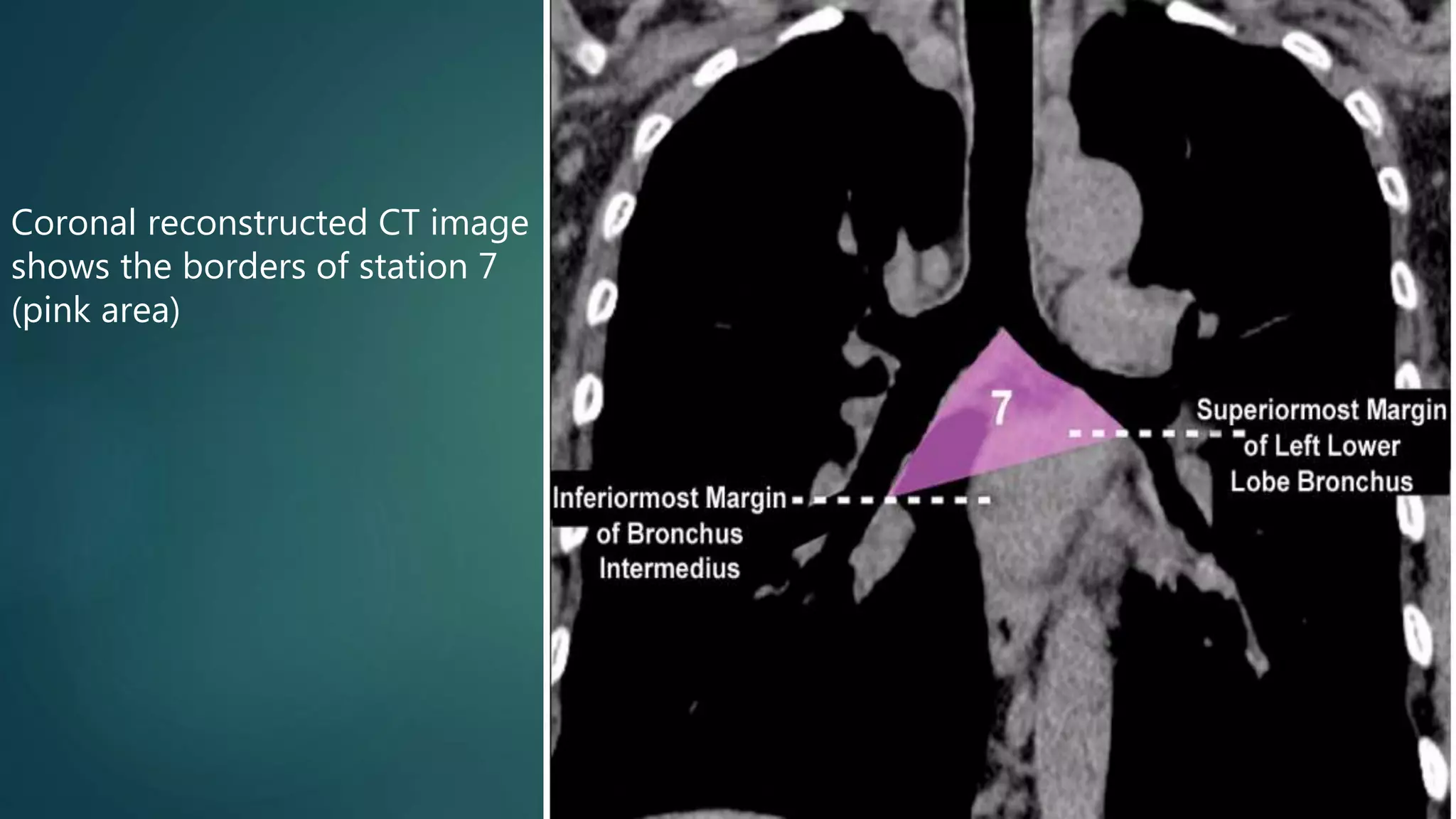 radiological anatomy of thoracic lymph nodes | PPTX