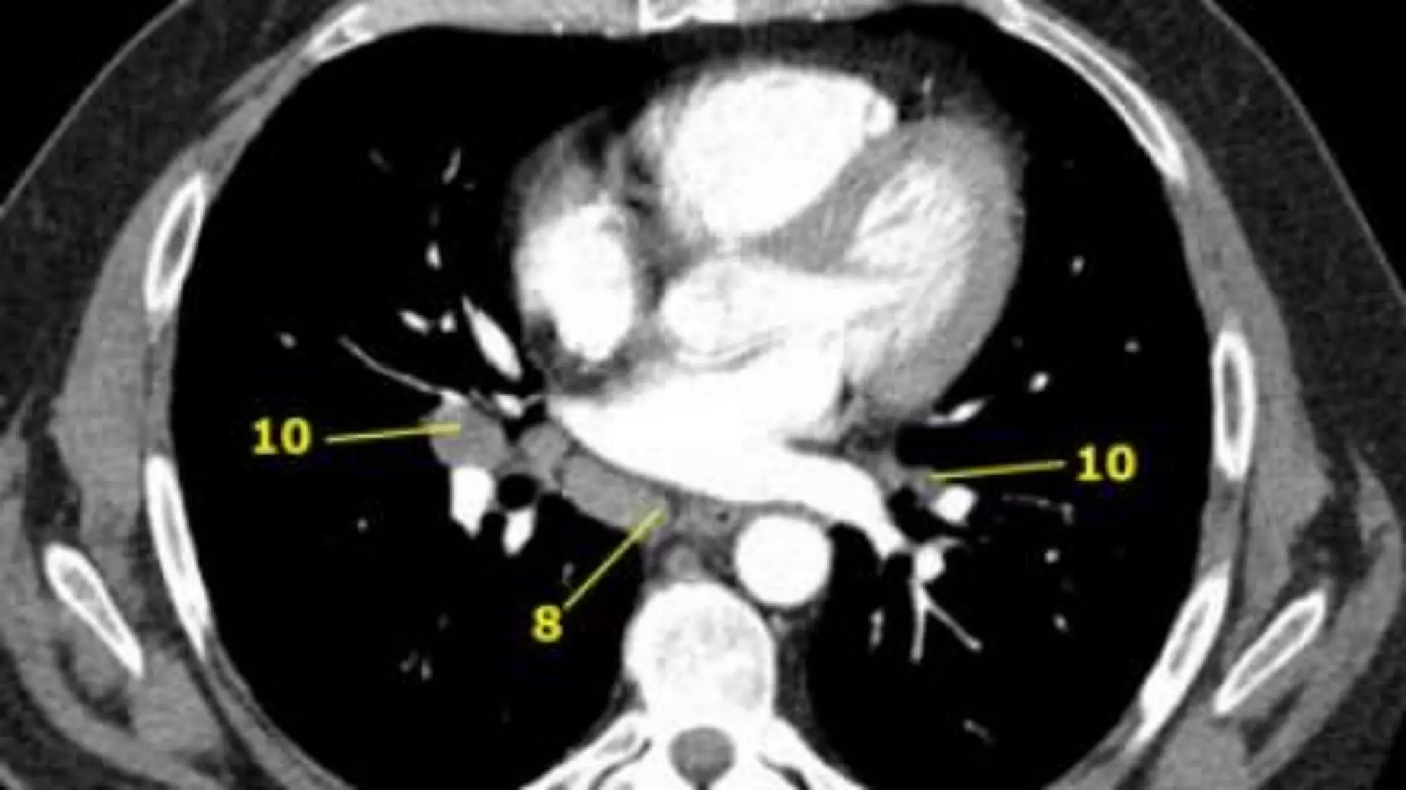 radiological anatomy of thoracic lymph nodes | PPTX | Death, Injury, or ...