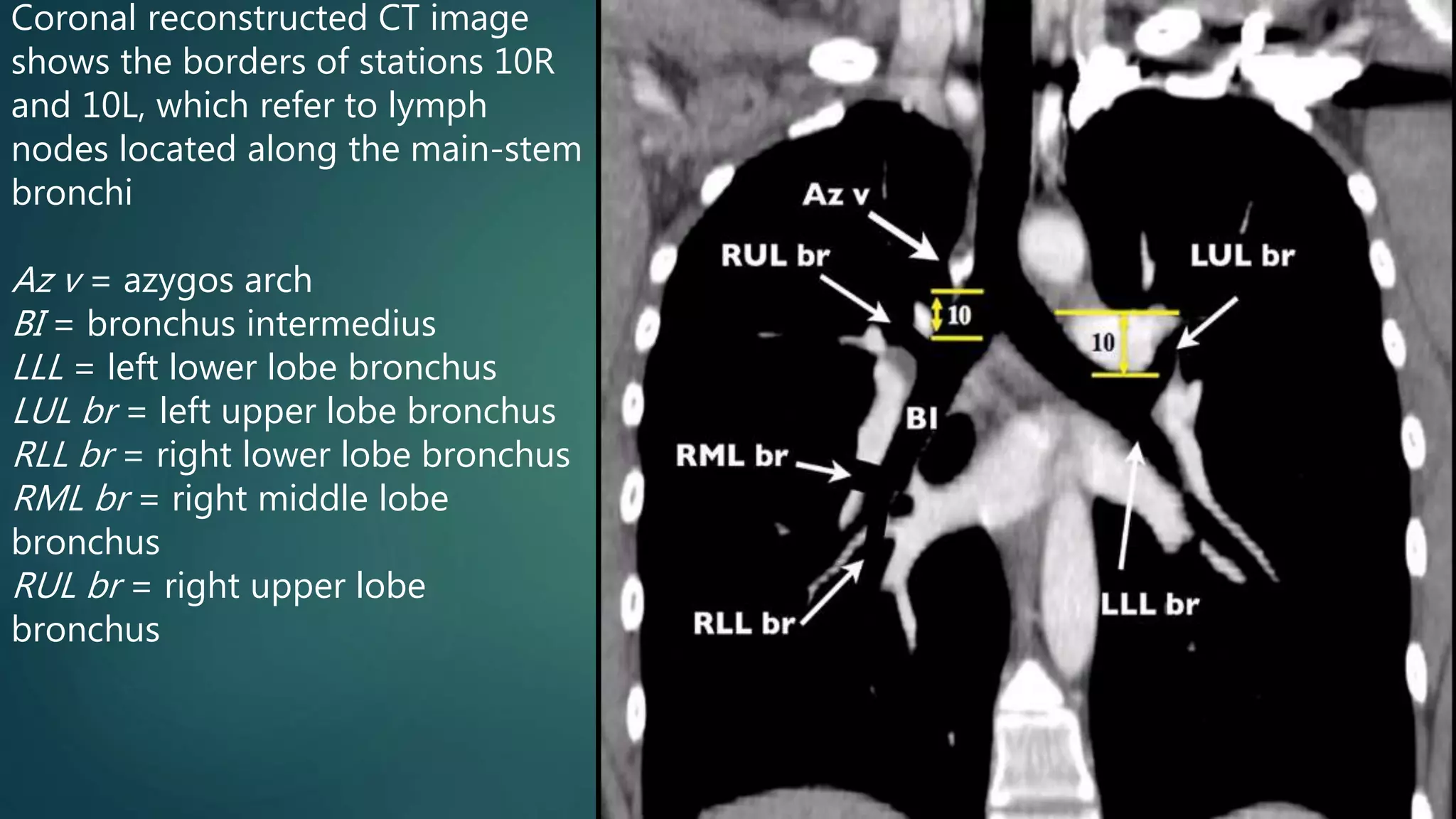 radiological anatomy of thoracic lymph nodes | PPTX