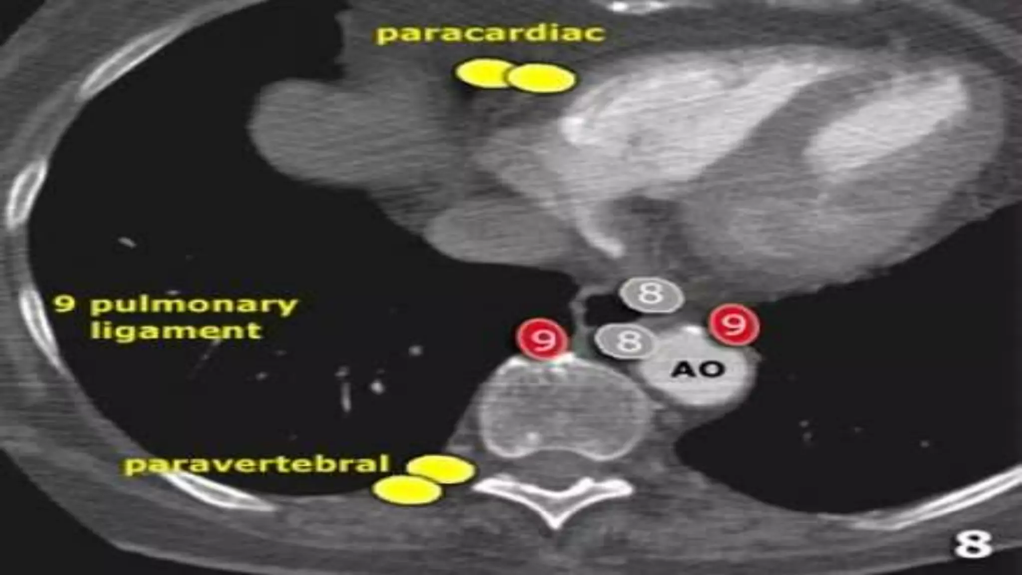 radiological anatomy of thoracic lymph nodes | PPTX