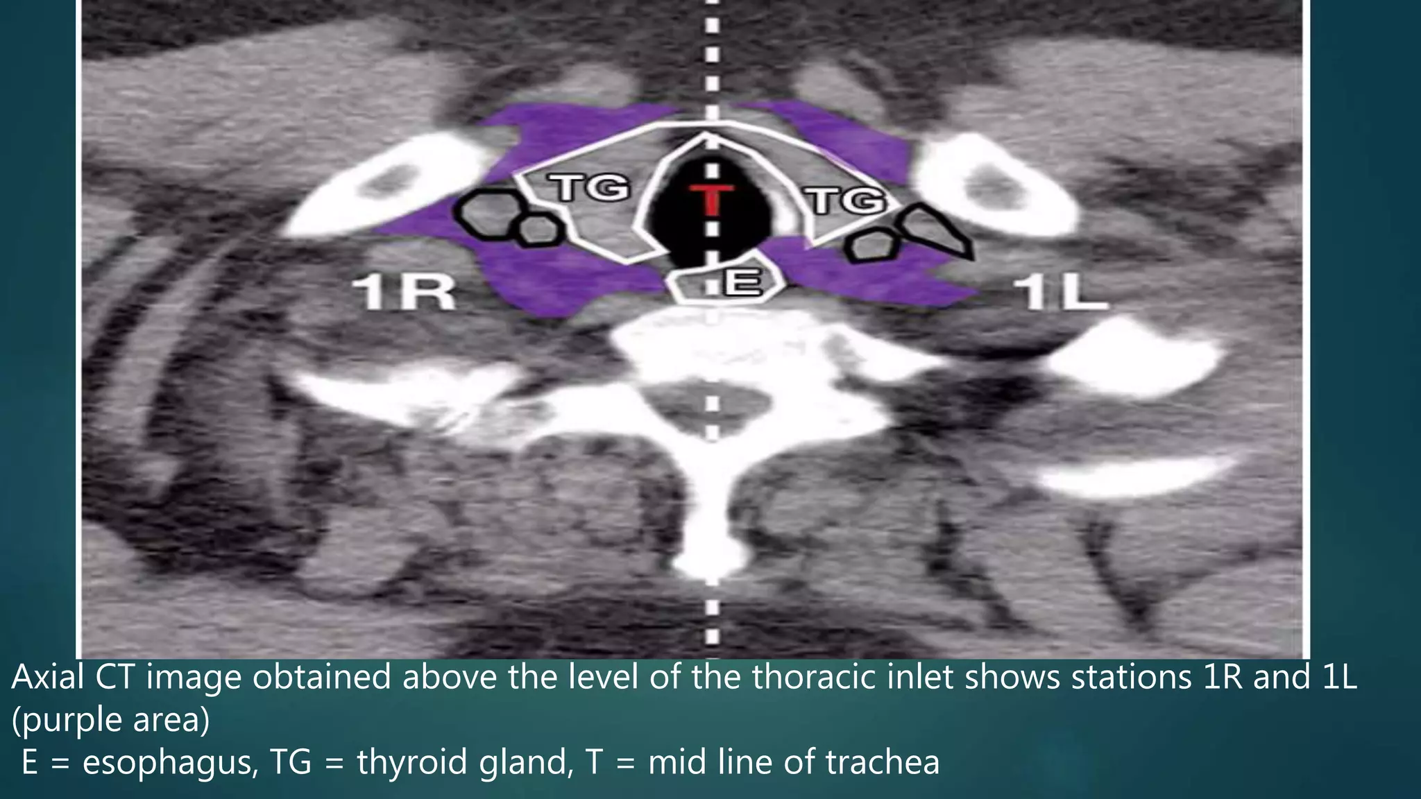 radiological anatomy of thoracic lymph nodes | PPTX