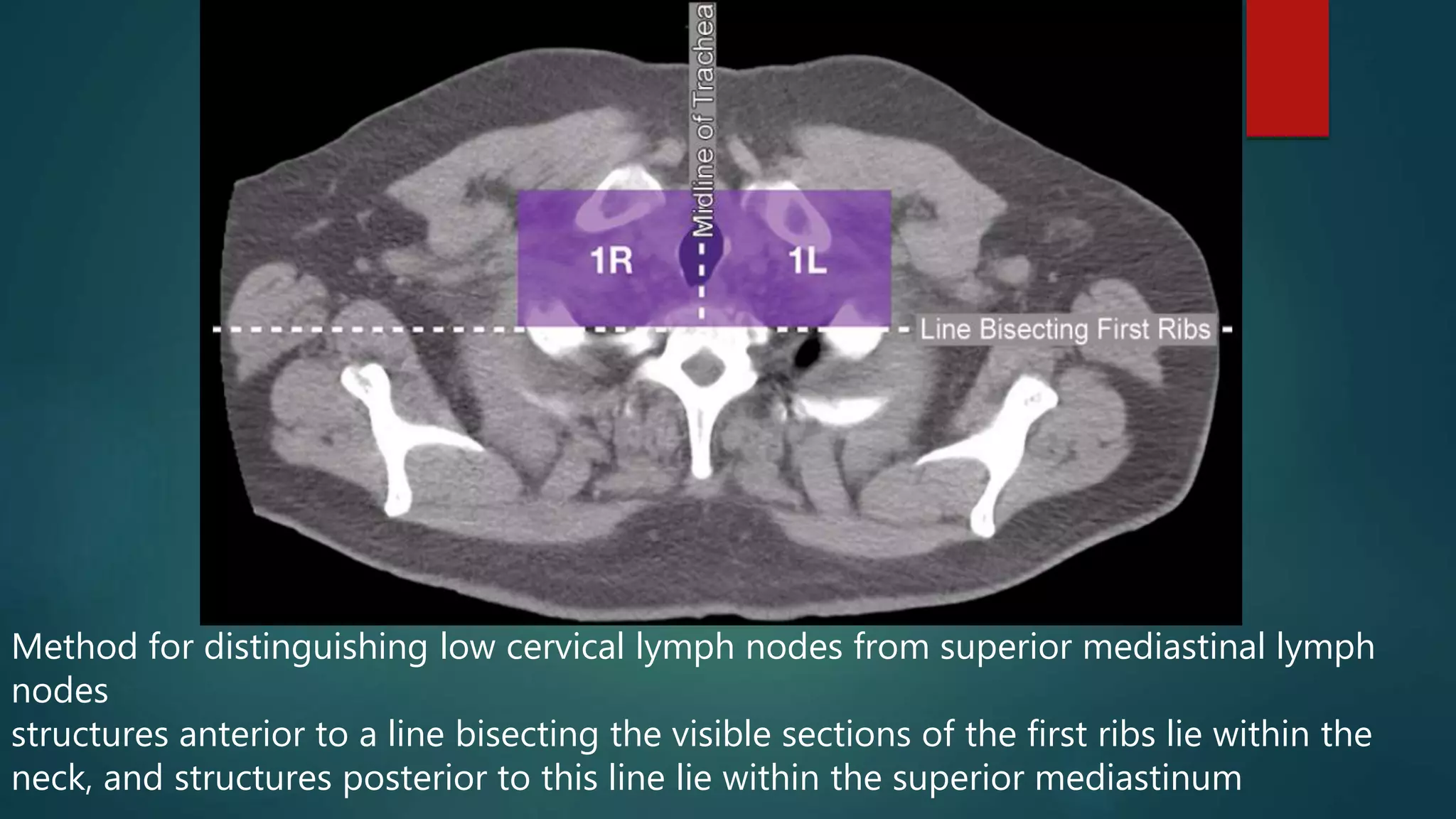 radiological anatomy of thoracic lymph nodes | PPTX