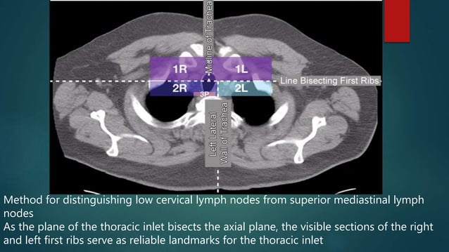 radiological anatomy of thoracic lymph nodes | PPTX | Death, Injury, or ...
