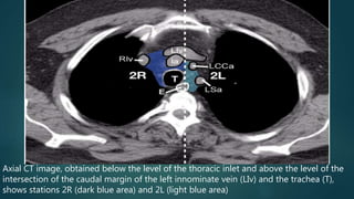 radiological anatomy of thoracic lymph nodes | PPTX