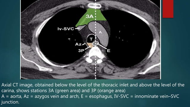radiological anatomy of thoracic lymph nodes | PPT