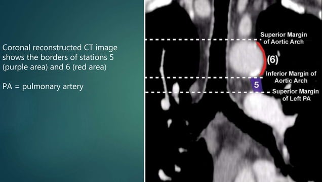 radiological anatomy of thoracic lymph nodes | PPTX | Death, Injury, or ...