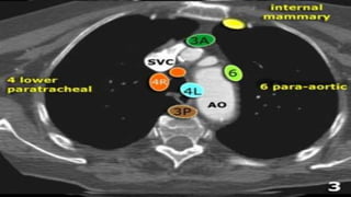 radiological anatomy of thoracic lymph nodes | PPTX