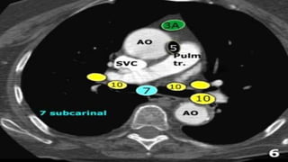 radiological anatomy of thoracic lymph nodes | PPTX