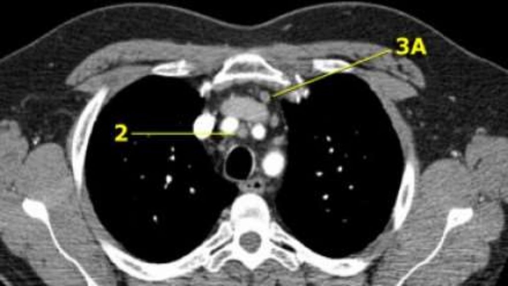 radiological anatomy of thoracic lymph nodes