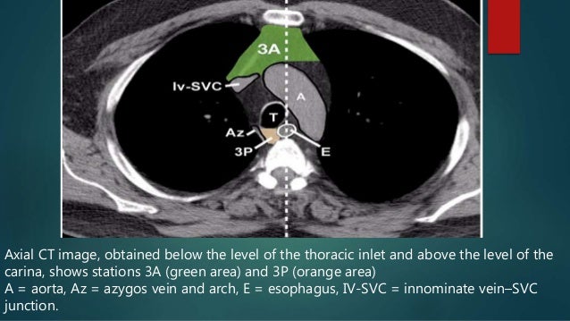 radiological anatomy of thoracic lymph nodes