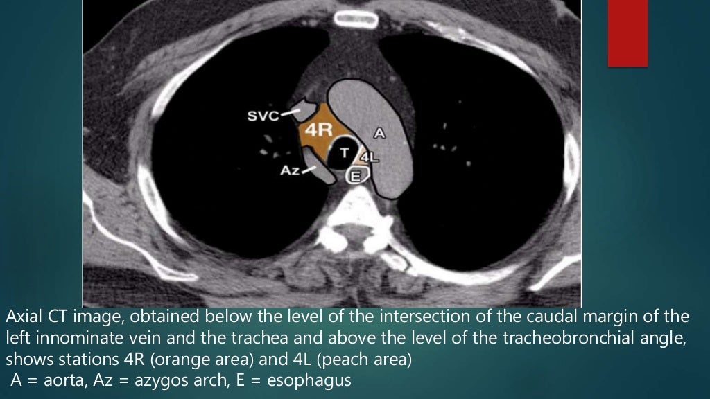 radiological anatomy of thoracic lymph nodes