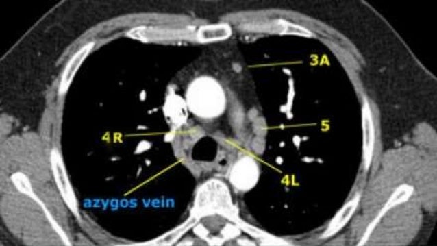 radiological anatomy of thoracic lymph nodes