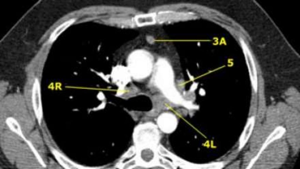 radiological anatomy of thoracic lymph nodes