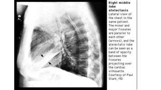 right middle lobe collapse | PPTX | Lung and Respiratory Health ...