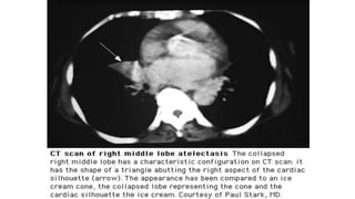 right middle lobe collapse | PPTX