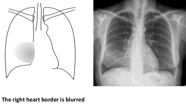 right middle lobe collapse