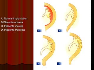1.abnormal adherence of placenta | PPT