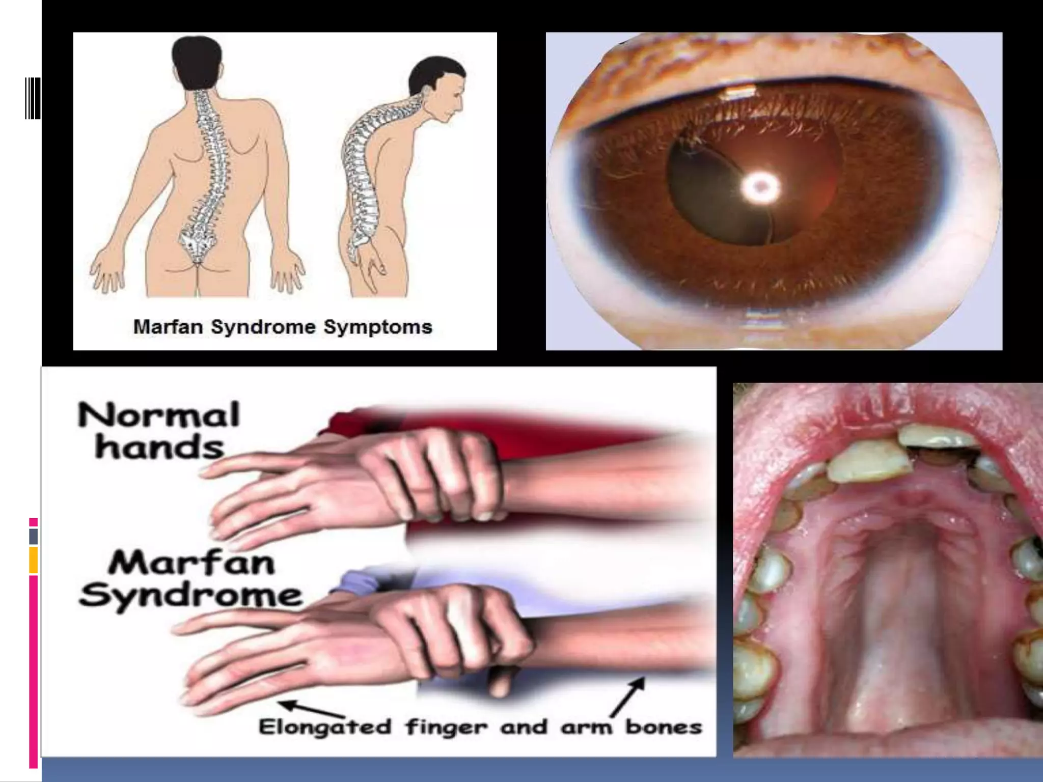 Marfan Syndrome | PPTX