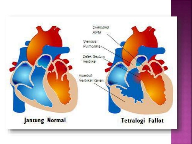 TETRALOGI OF FALLOT | PPTX