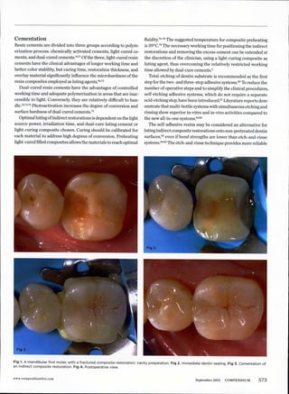 1. adhesive cementation of indirect composite inlays and onlays. a ...