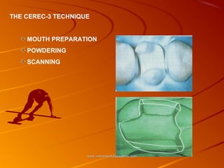 AN OVERVIEW OF THE CEREC 3D CAD/CAM SYSTEM / dental implant courses by ...