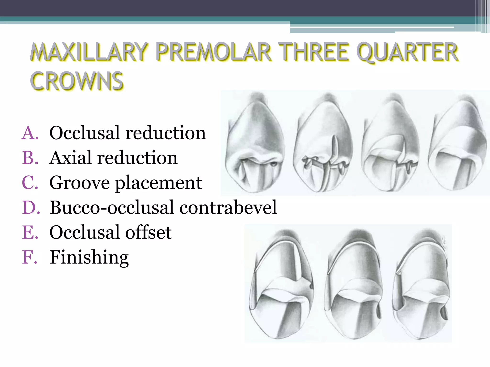 Tooth preparation for partial veneer crwns | PPTX