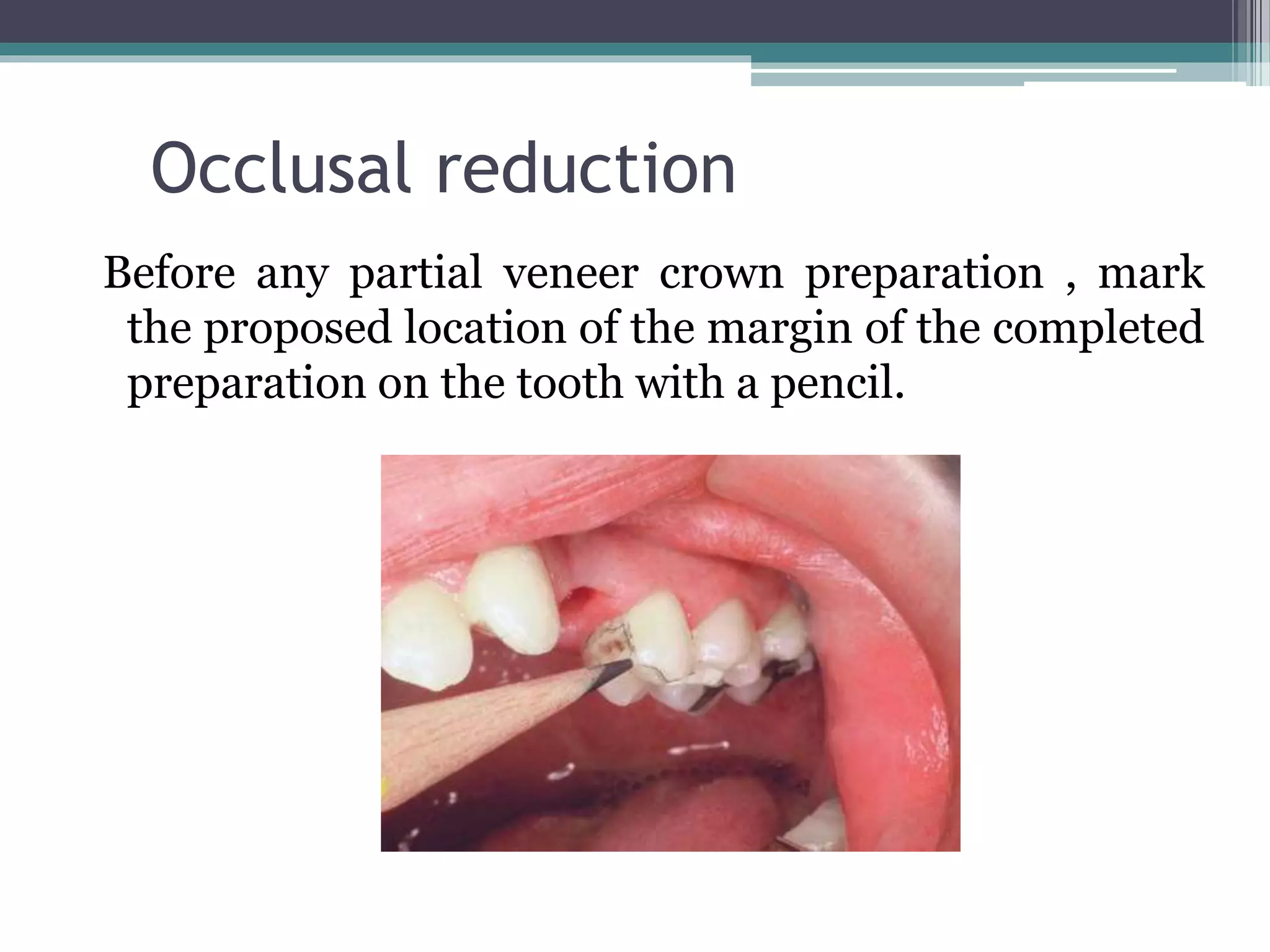 Tooth preparation for partial veneer crwns | PPTX