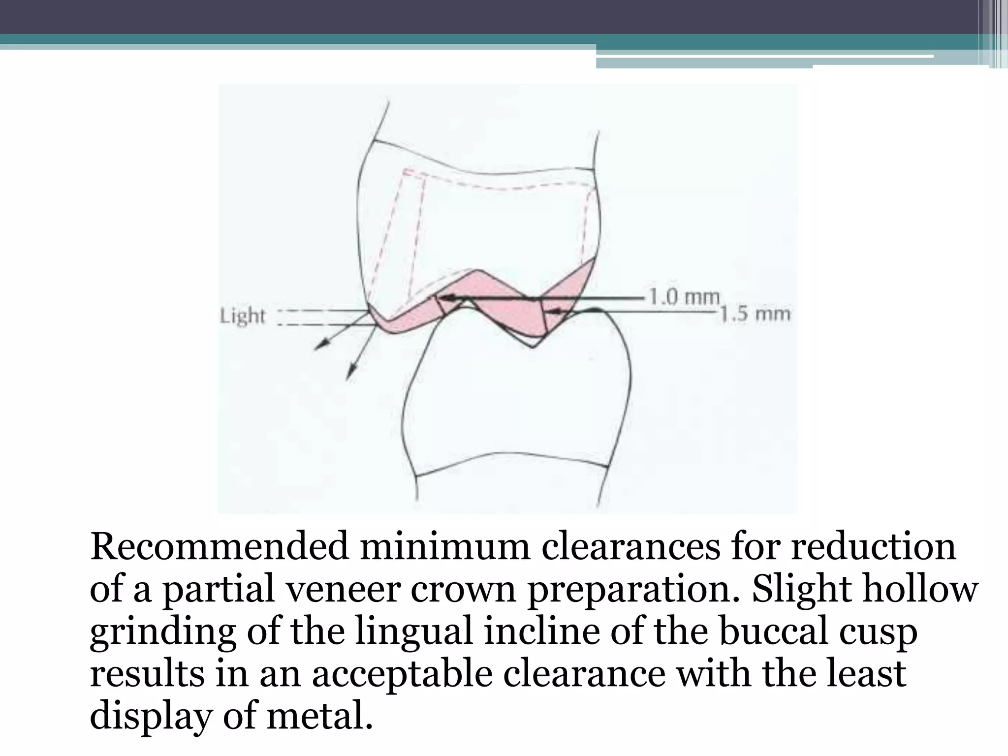 Tooth preparation for partial veneer crwns | PPTX