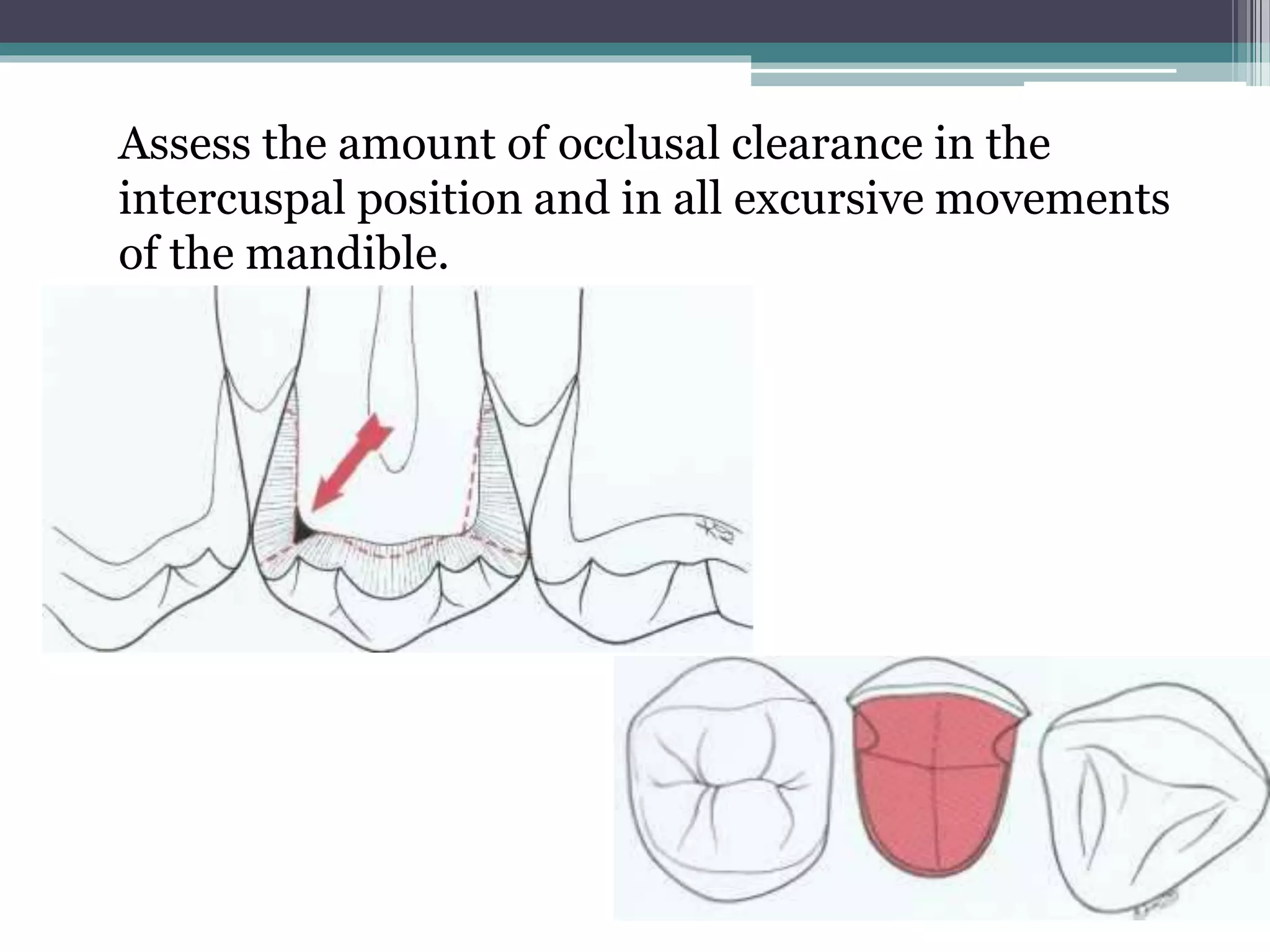 Tooth preparation for partial veneer crwns | PPTX