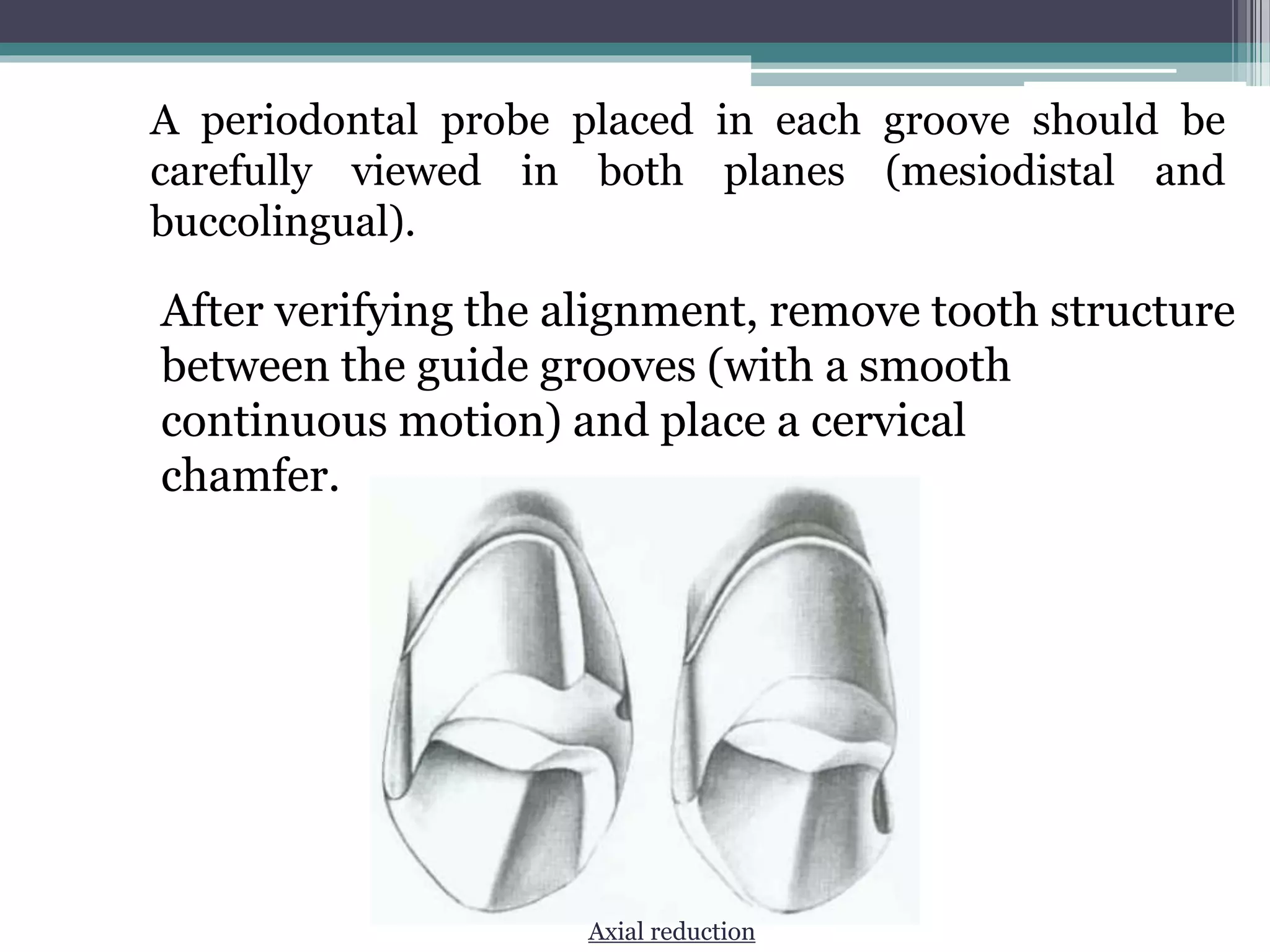 Tooth preparation for partial veneer crwns | PPTX
