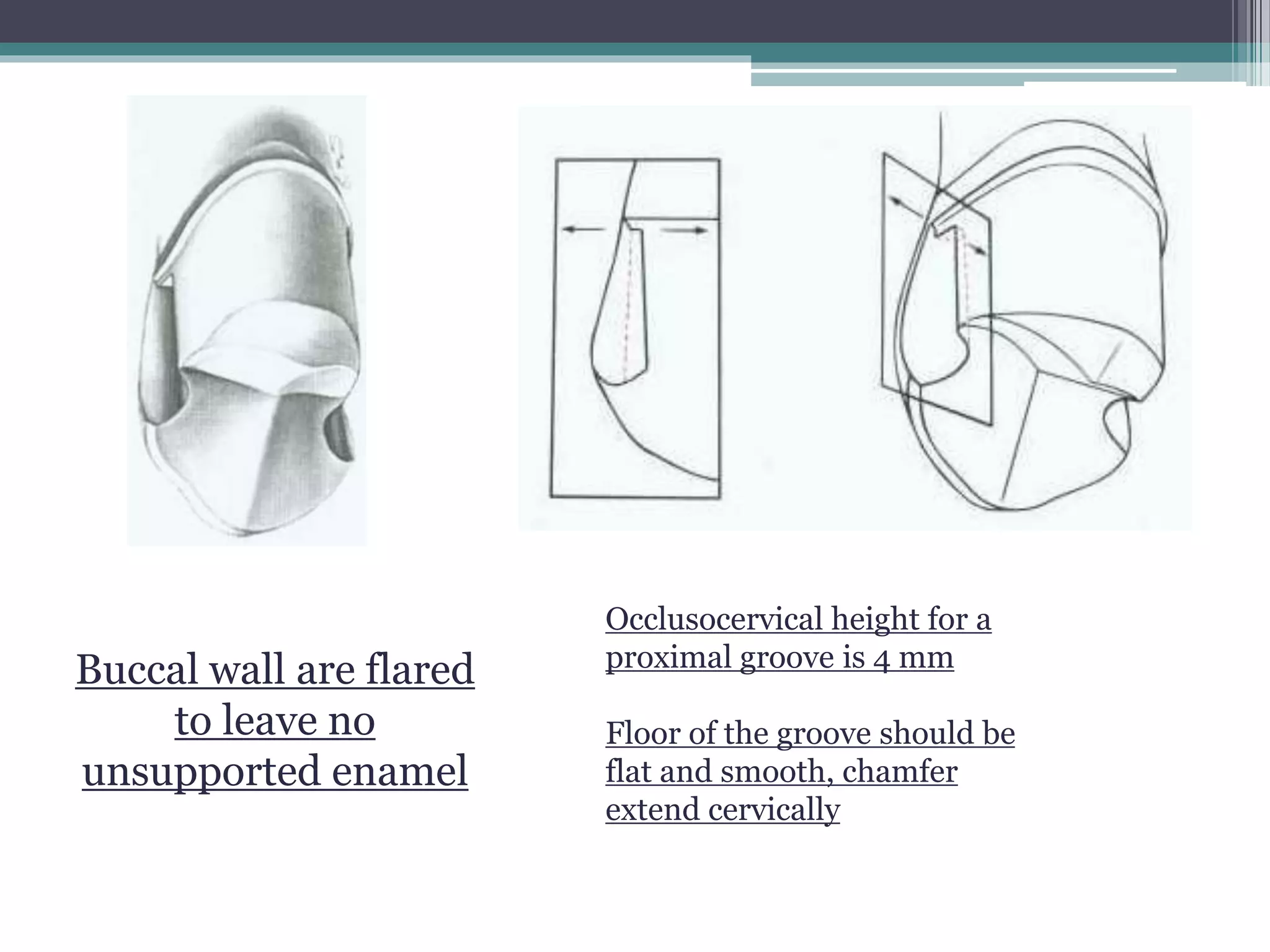 Tooth preparation for partial veneer crwns | PPTX