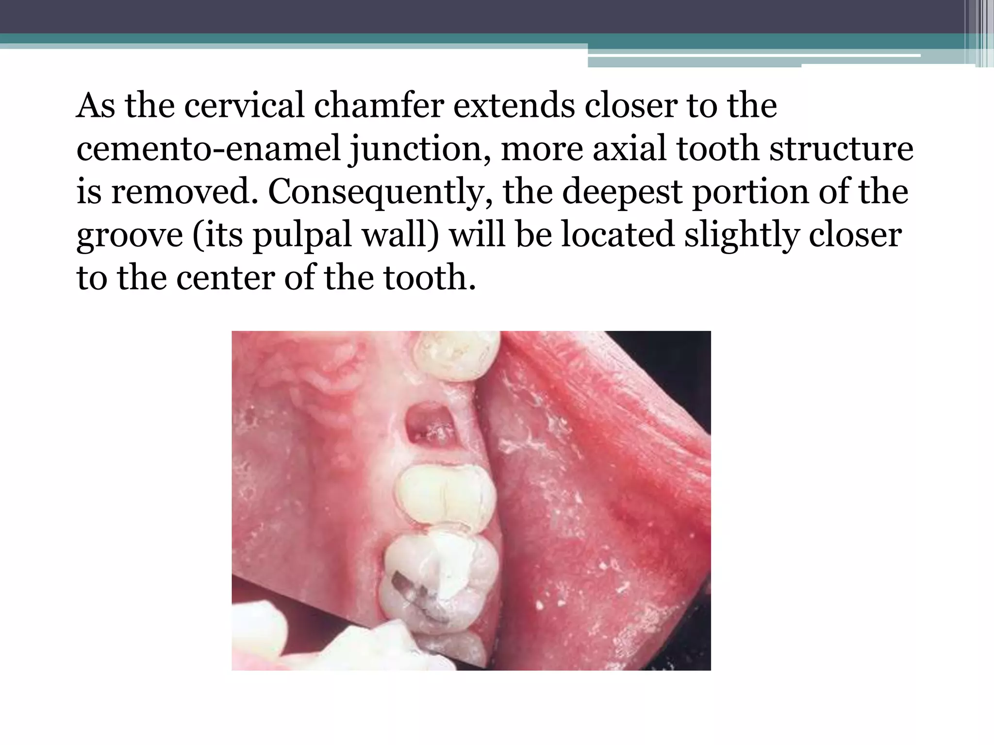Tooth preparation for partial veneer crwns | PPTX