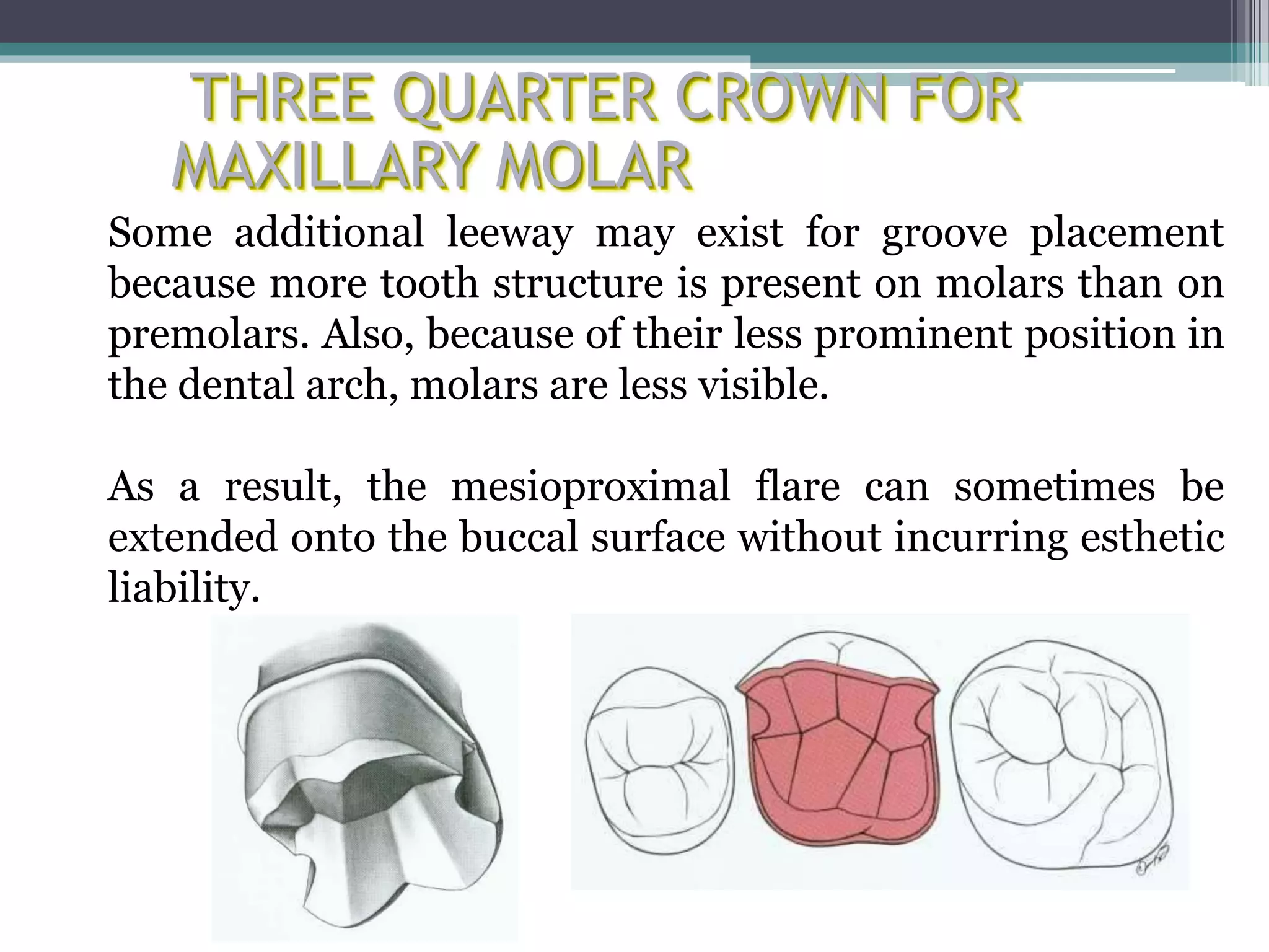 Tooth preparation for partial veneer crwns | PPTX