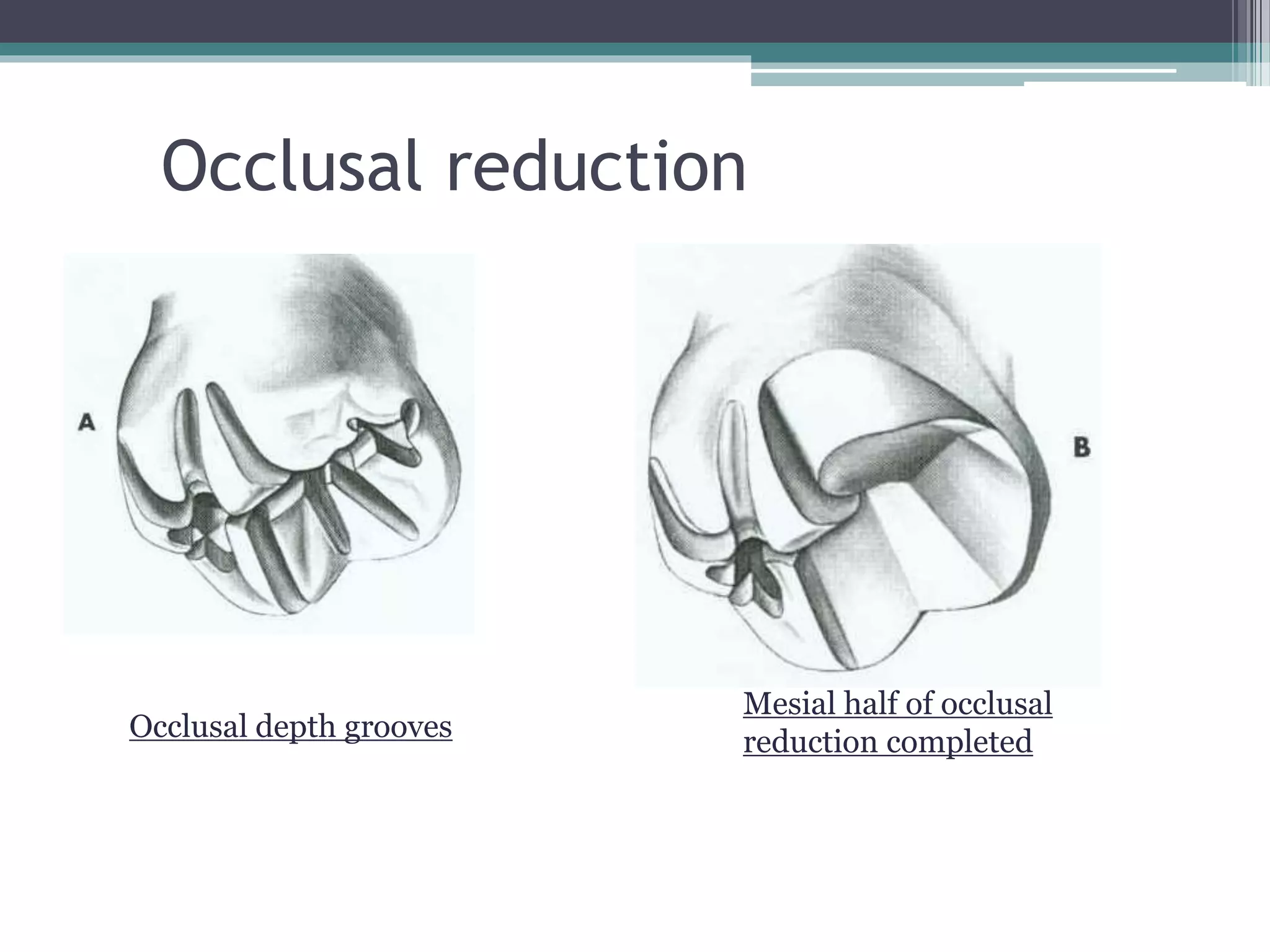 Tooth preparation for partial veneer crwns | PPTX