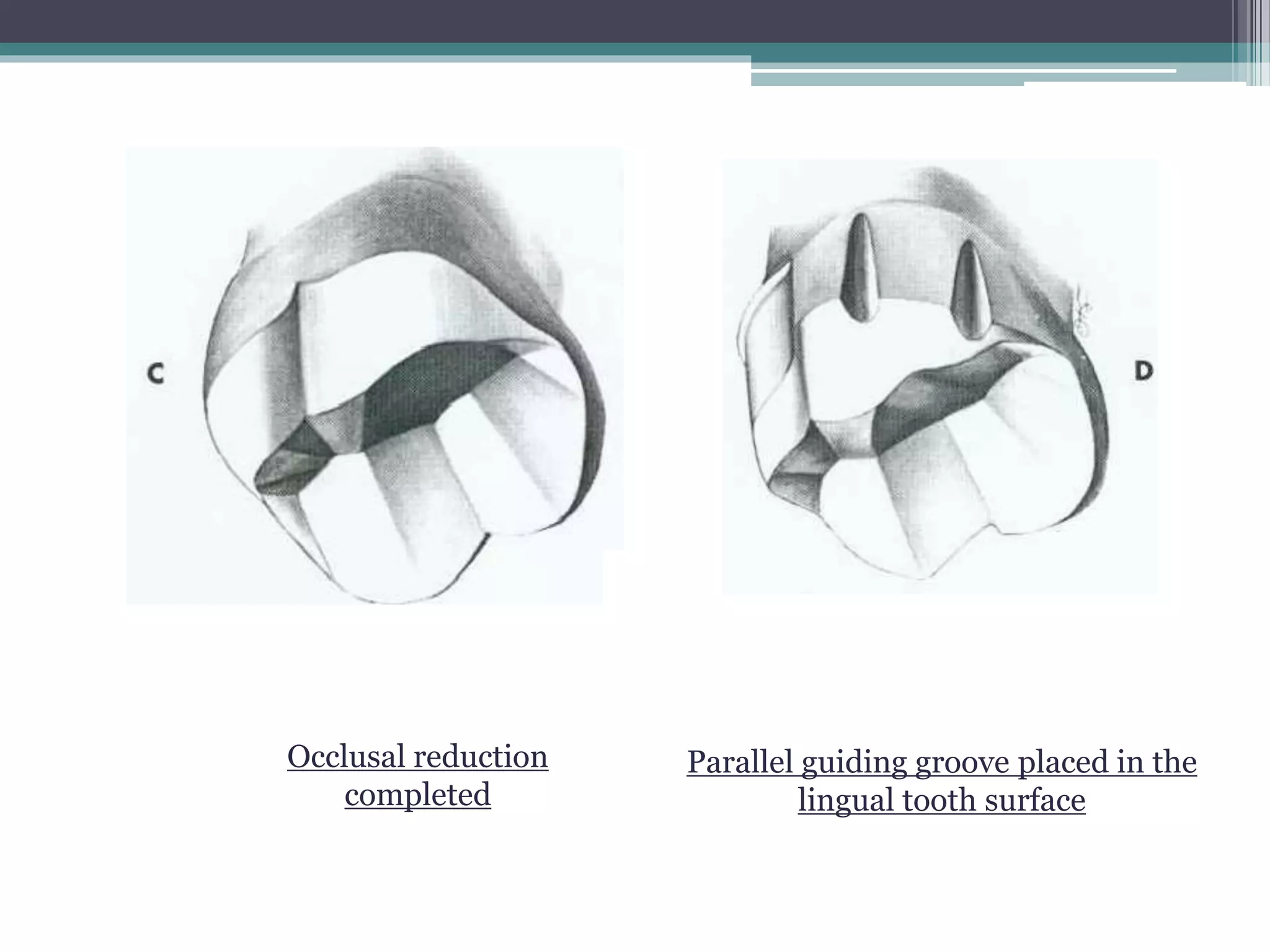 Tooth preparation for partial veneer crwns | PPTX