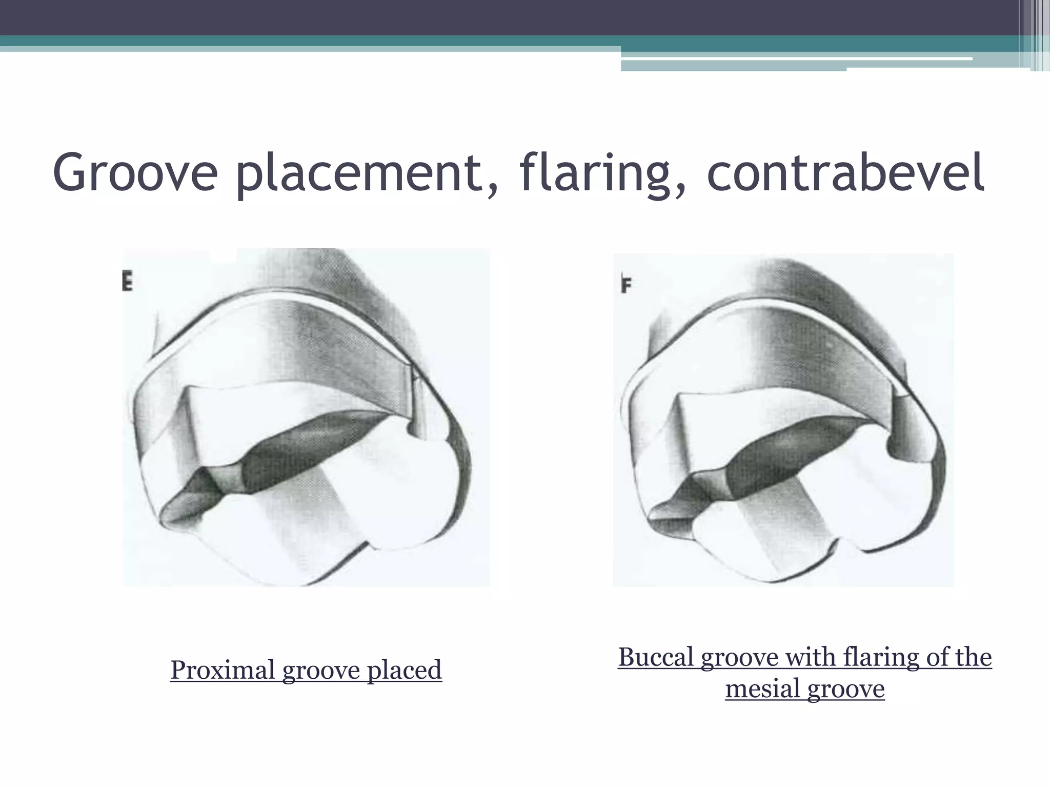 Tooth preparation for partial veneer crwns | PPTX