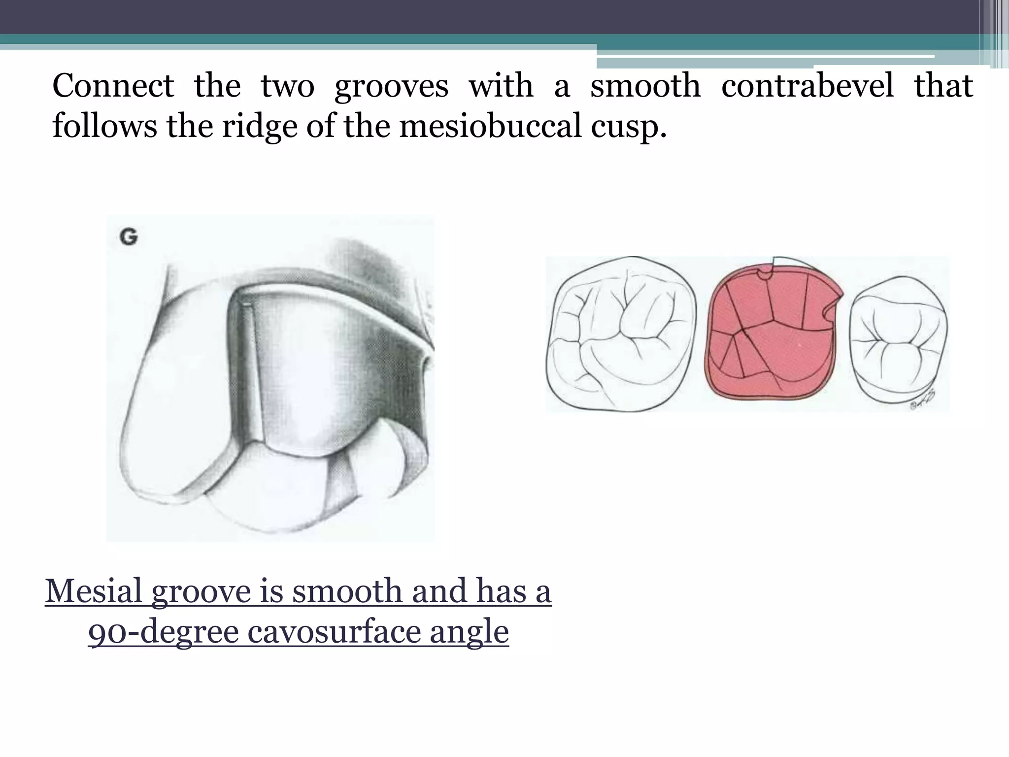 Tooth preparation for partial veneer crwns | PPTX