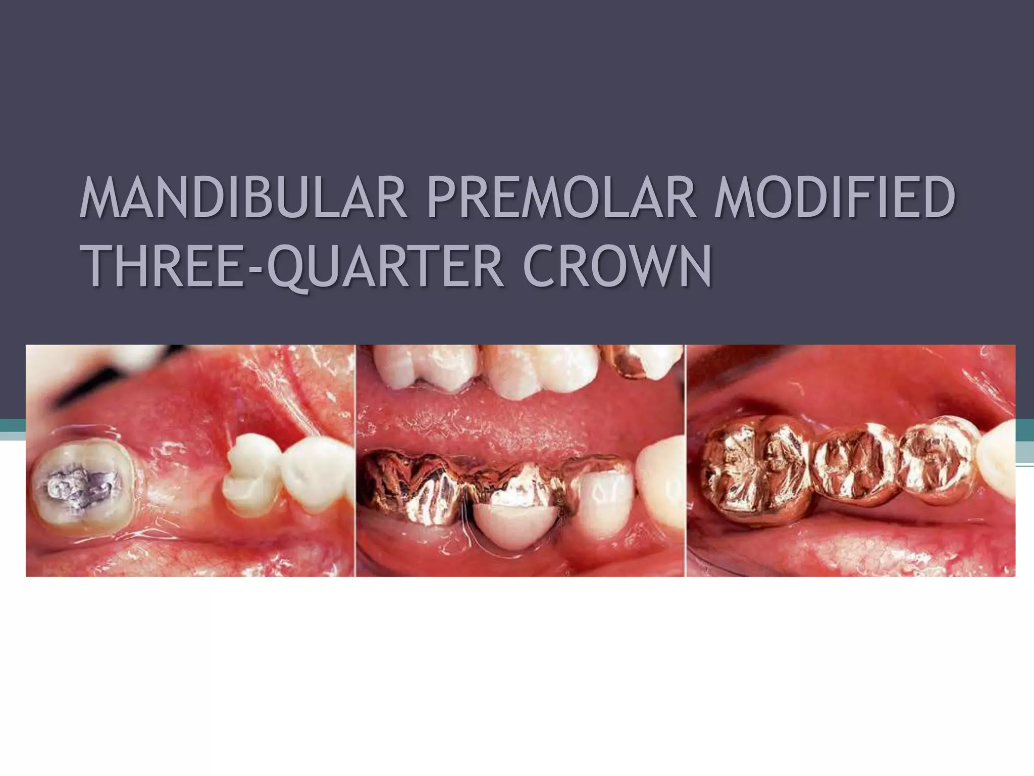 Tooth preparation for partial veneer crwns | PPTX