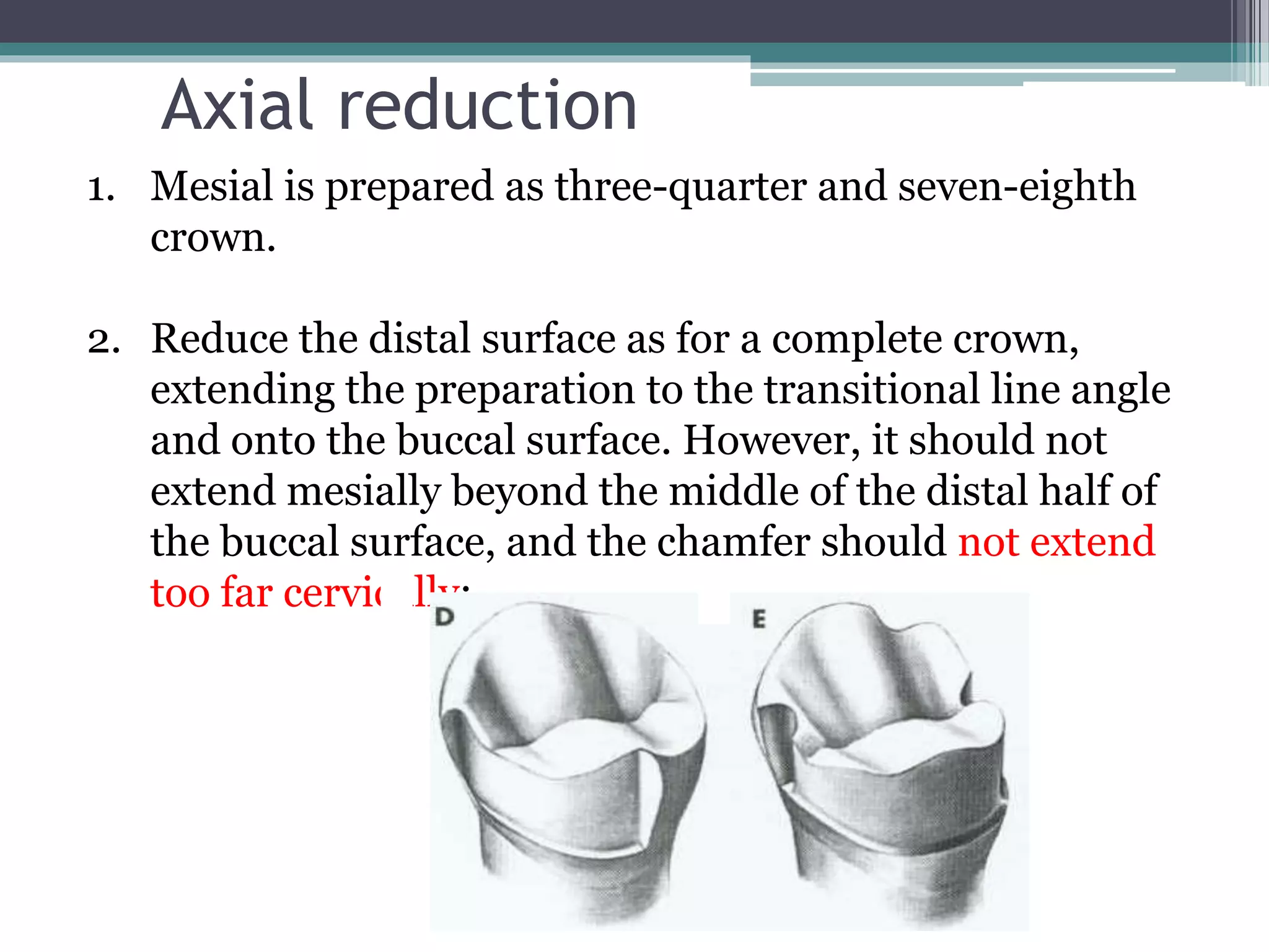 Tooth preparation for partial veneer crwns | PPTX