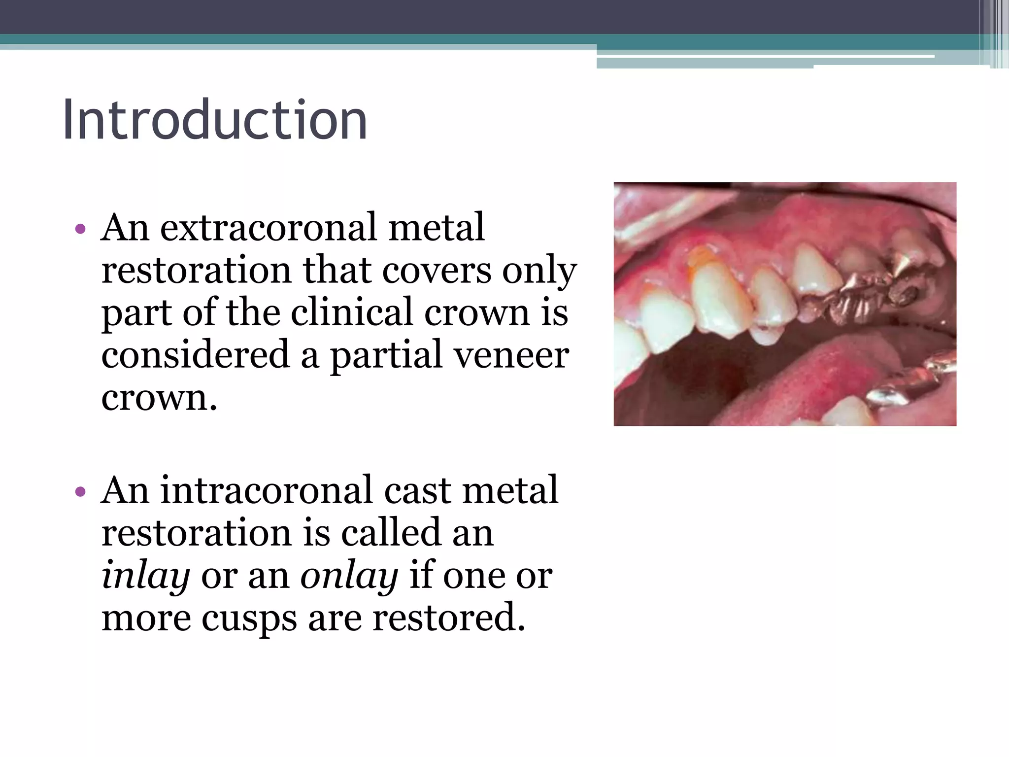 Tooth preparation for partial veneer crwns | PPTX